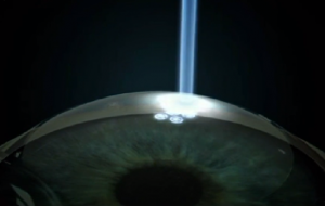 Eye Surgery & Vision Correction Ventura County | DLV Vision