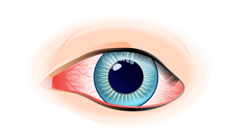 What Are The Causes and Treatments Subconjunctival Hemorrhage?