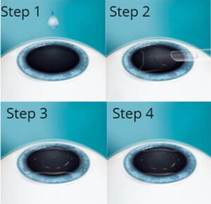 EVO ICL Surgery in Los Angeles & Ventura County | DLV Vision